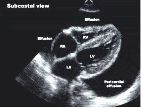 Pericardial Effusion Echo