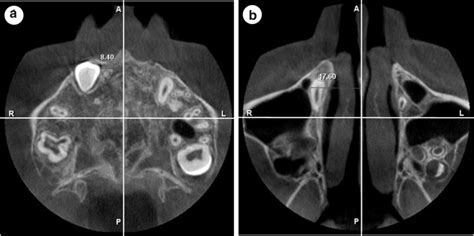 Cbct Image Axial View Illustrating The Perpendicular Measurements Download Scientific Diagram
