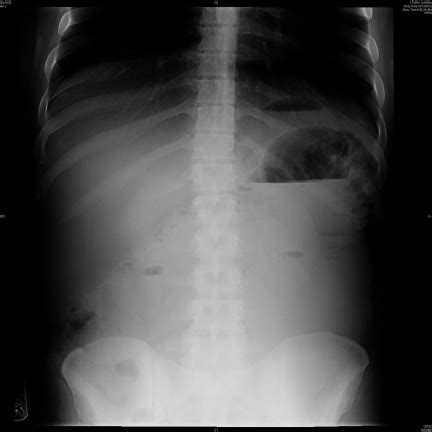 An Erect Abdominal Radiograph Which Revealed Multiple Air Fluid Levels Download Scientific