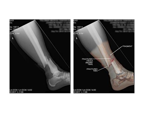 Open Fracture Of Tibia And Fibula X Rays Bild Kaufen 11681828