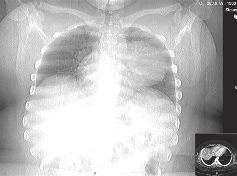 Pericardial Cyst Consultant360