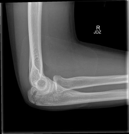 Olecranon Fossa X Ray