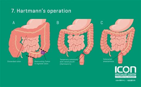 Colorectal Resection Colectomy — Icon Specialist Centre