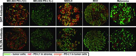 Examples Of Strong Pd L1 Fluorescent Staining Staining Is Shown In