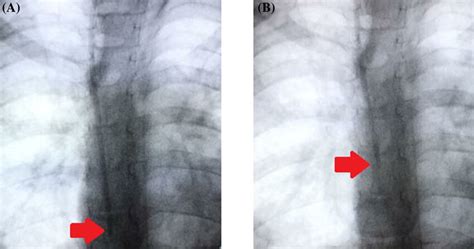 Anteroposterior Chest Radiography Images After Placement Of A Central