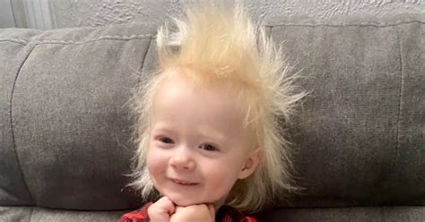 Girl 3 With Uncombable Hair Syndrome Means She Cant Control Her