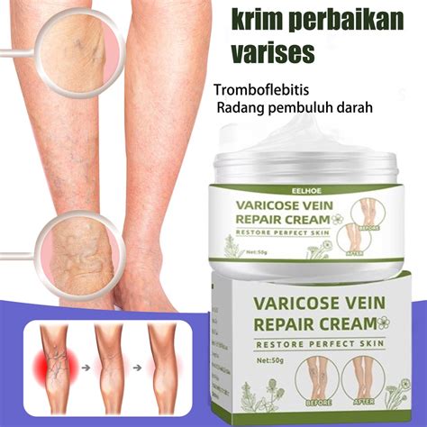 Jual Obat Varises Salep Penghilang Bekas Penghilang Varises Cream 50g