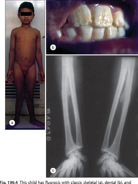 Figure 1998 From Osteomalacia And Rickets Semantic Scholar