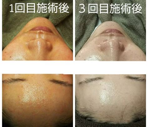 荒れたお肌がサロンケアとスキンケアで改善 奈良大和高田 小顔矯正と美肌 で若々しく変化！まごころエステmatoria ブログ 小顔と美肌