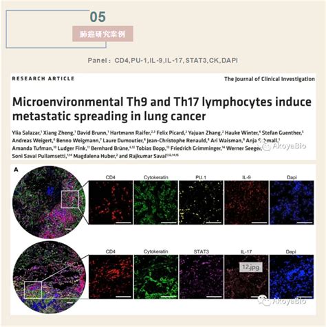 热点分享tma组织微阵列芯片opal多重荧光定量病理分析研究案例赏析 云准医药科技（上海）有限公司