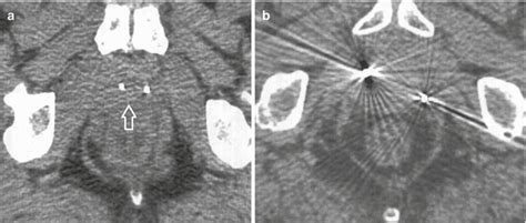 Fiducial Marker Implantation In Prostate Radiation Therapy Abdominal Key