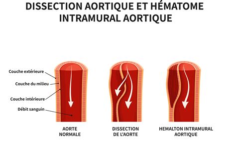 Dissection Aortique Causes Symptômes Traitements