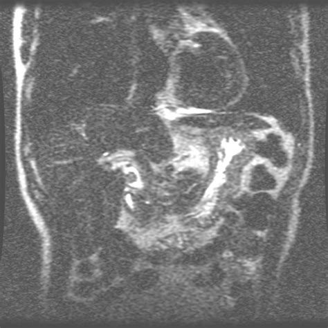 Biliary Tumors 1632 Mrcp Bile Duct Papilloma Surgery Photos