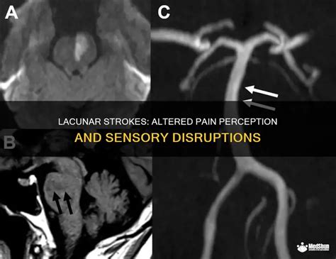 Lacunar Strokes Altered Pain Perception And Sensory Disruptions Medshun