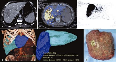 Transarterial Radioembolization For Liver Tumors As Neoadjuvant Therapy Three Case Reports