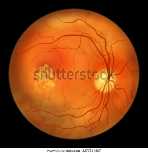 Best Disease Best Vitelliform Macular Dystrophy Stock Illustration