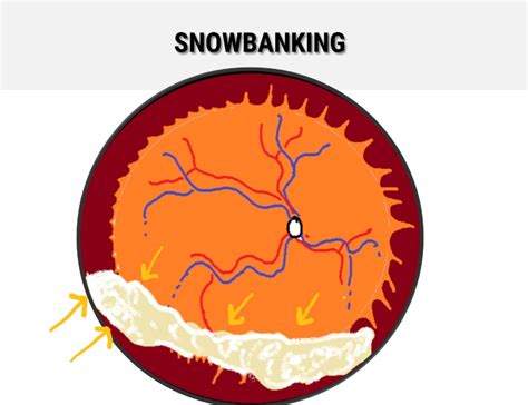 Intermediate Uveitis Understanding Symptoms Signs And Complications Insight Ophthalmology