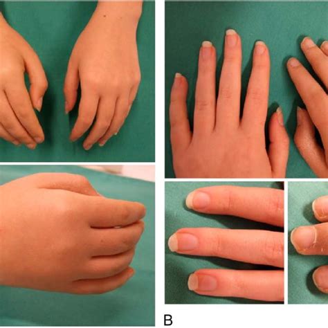 Partial Crps Type 1 Of The Hand Proposed Diagnostic Flow Chart