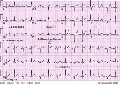 What Is A Normal 12 Lead Ecg at Paul Jamison blog