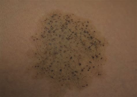 Vellus Hair Nevus At Joanne Tindall Blog