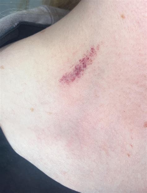 What Could Cause Hickey Like Mark On Neck R Skin