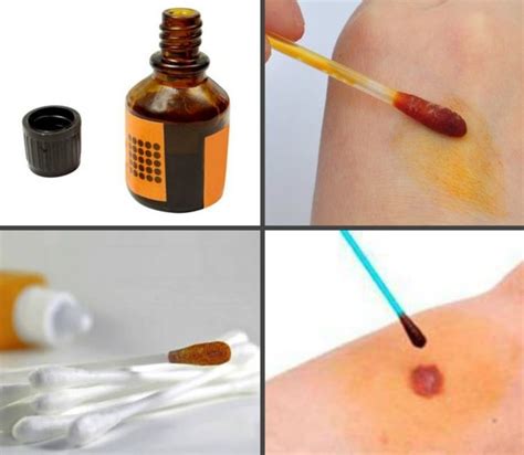 Можно ли прижигать папилломы йодом? Отзывы и лечение