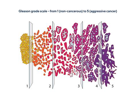 Your Gleason Score And Isup Grade Pcfa