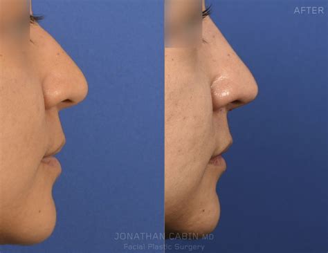 Non Surgical Rhinoplasty Before And Afters Dr Jonathan Cabin