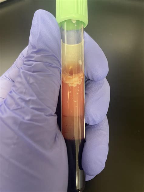 The Weirdest Lipemic Specimen Ive Seen Rmedlabprofessionals