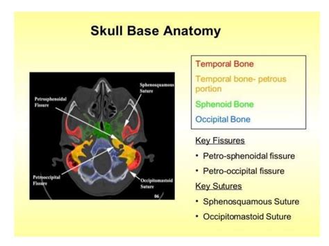 Chondrosarcoma Of Skull Base Radiology Point Of View Ppt