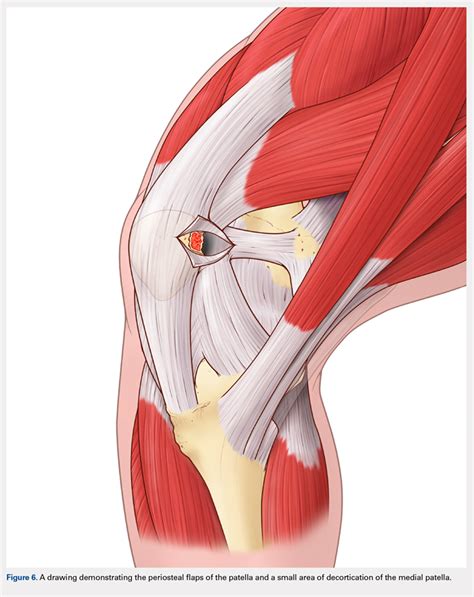 Medial Patellar Retinaculum