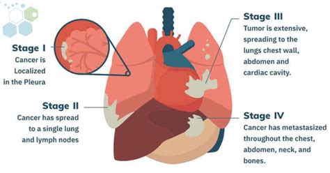 Immunotherapy And Stem Cells For Mesothelioma