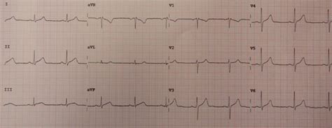 The Patients Electrocardiogram Showed Sinus Rhythm With Pr Segment