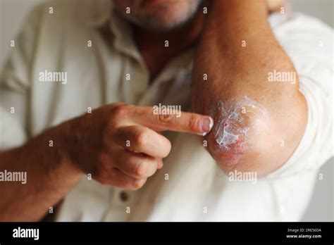 Applying An Cream Emollient To Dry Flaky Skin As In The Treatment Of