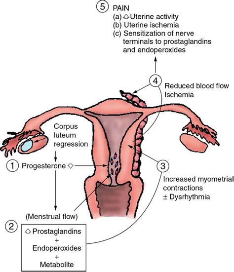Primary And Secondary Dysmenorrhea Premenstrual Syndrome And