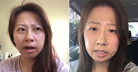 Australian Woman Wakes Up After Tonsil Surgery With An Irish Accent
