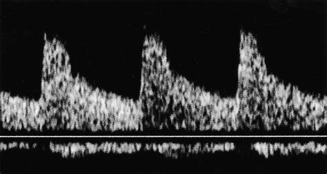 Normal Intra Renal Arterial Waveform Showing A Sharp Systolic Upstroke Download Scientific