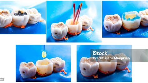 Post And Core Buildup Of Root Canal Treated Tooth Recent Materials And Methods