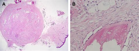 Figure 1 From Ossifying Fibromyxoid Tumor A Case Report Semantic