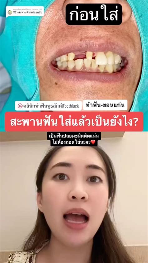 สะพานฟันใส่แล้วเป็นยังไง มาดูกันค่ะ 😊 หมอณัฐคุณ คลินิกทันตกรรมทูธลัก