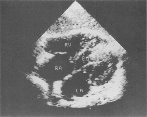 Parachute Malformation Of Mitral Valve Semantic Scholar