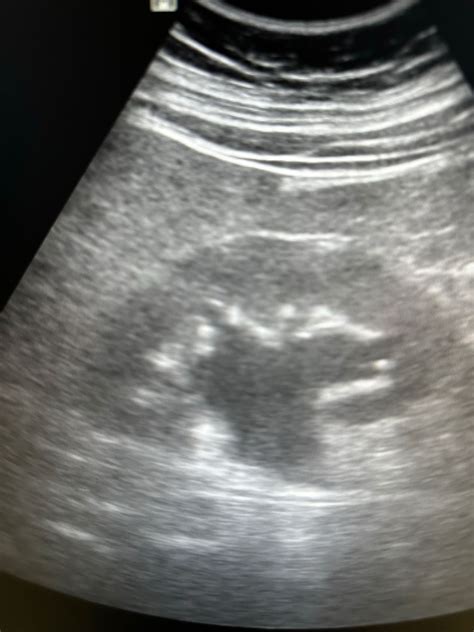 Meshal Alhushayyan On Linkedin Hydronephrosis Occurs When The Renal