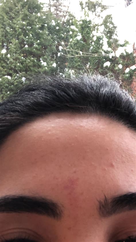 Rough Bumpy Leathery Forehead Texture General Acne Discussion