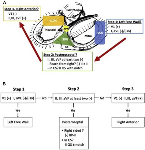 algorithms to identify accessory pathways location on the 12 lead
