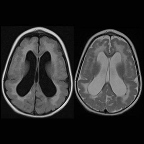 Pediatric Pachygyria Pediatric Radiology Reference Article