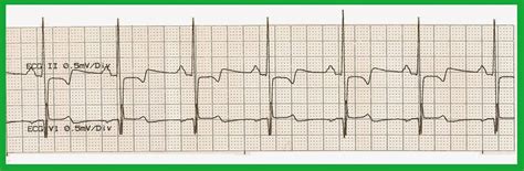 Various Normal Sinus Rhythms