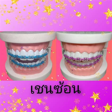 รีเทนเนอร์ไร้เหงือก เชนซ้อน บน6ล่าง6 สินค้าแฟชั่น Dragon002 Thaipick