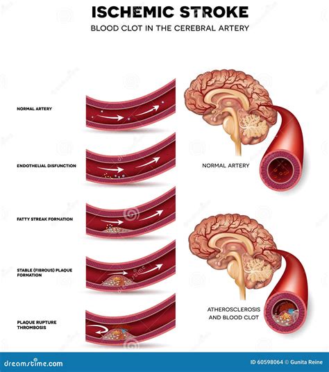 Cerebral Artery With Atherosclerosis Vector Illustration