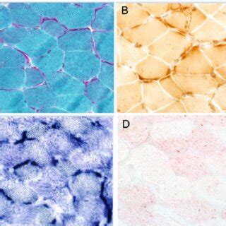 Histochemical And Immunohistochemical Analyses Of Muscle Biopsy A