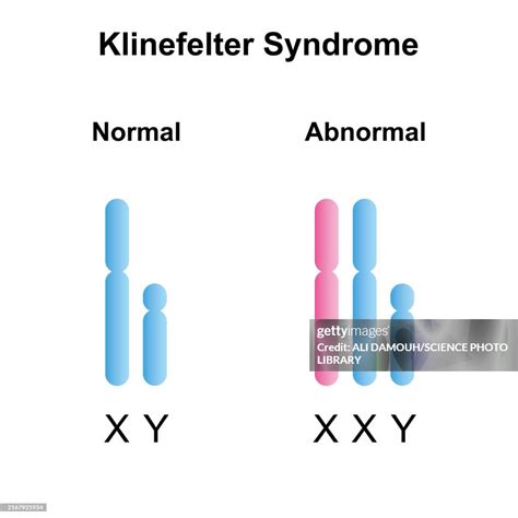 Klinefelter Syndrome Illustration High Res Vector Graphic Getty Images